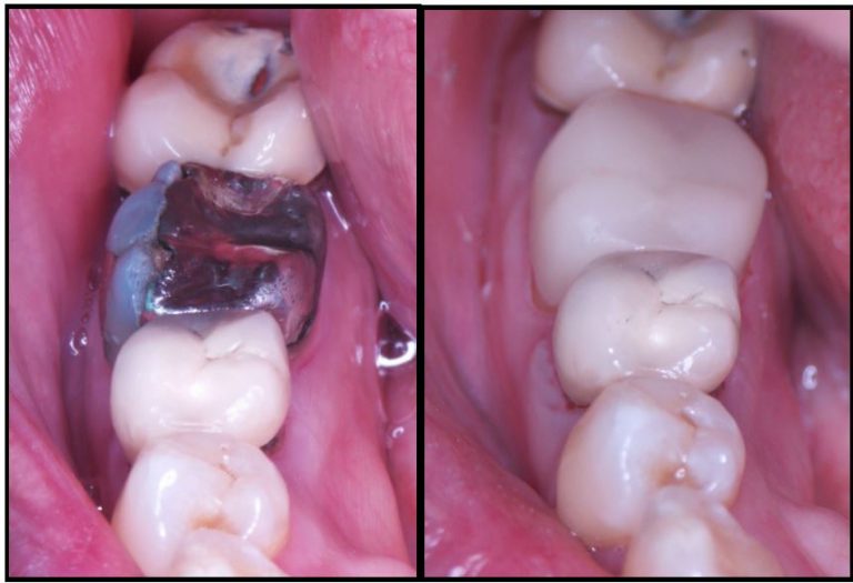 Mercury Free Fillings: Safe Dental Care in Mosman